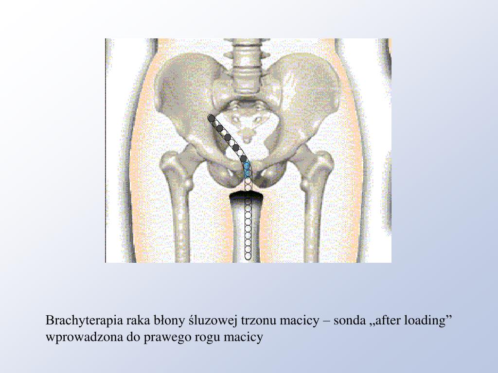 PPT - Metody diagnostyczne i terapeutyczne stosowane w onkologii ...