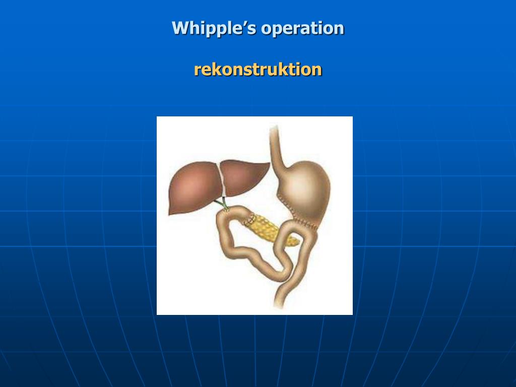 PPT - Cancer Pancreatis Diagnostik og behandling PowerPoint ...