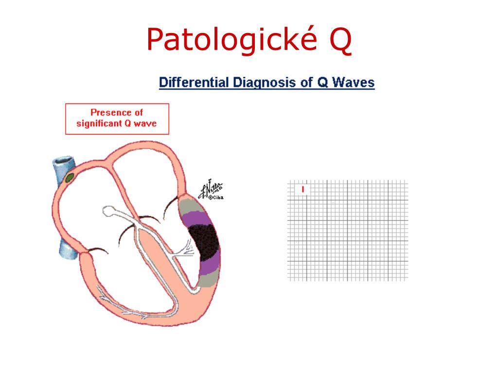 PPT - Základy elektrokardiografie (EKG) PowerPoint Presentation, free ...