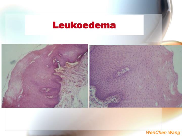 PPT - 1. White lesions of the oral mucosa 2. Solitary oral ulcer and ...