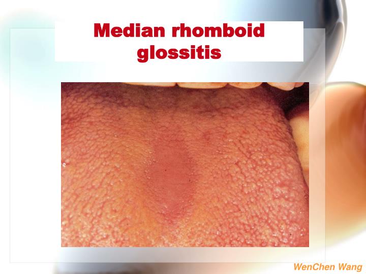 PPT - 1. White lesions of the oral mucosa 2. Solitary oral ulcer and ...