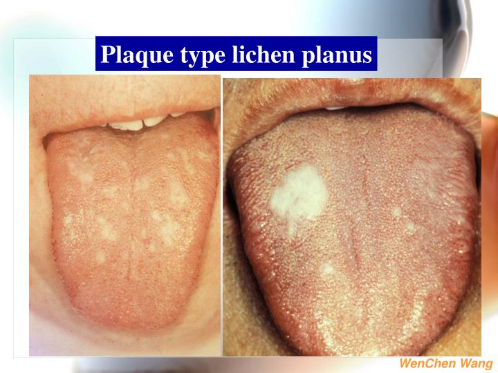 PPT - 1. White lesions of the oral mucosa 2. Solitary oral ulcer and ...