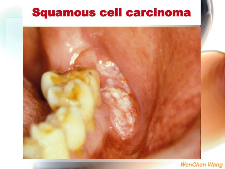 PPT - 1. White lesions of the oral mucosa 2. Solitary oral ulcer and ...