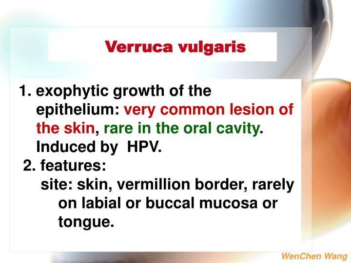 PPT - 1. White lesions of the oral mucosa 2. Solitary oral ulcer and ...
