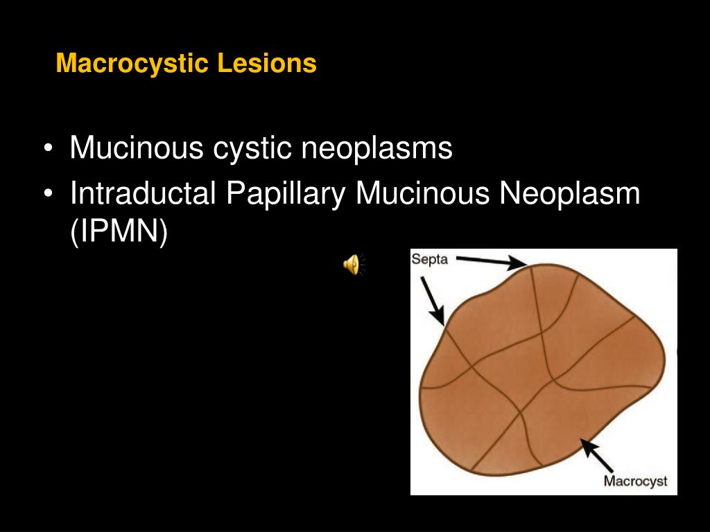 PPT - Imaging of Pancreatic Cystic Lesions PowerPoint Presentation ...