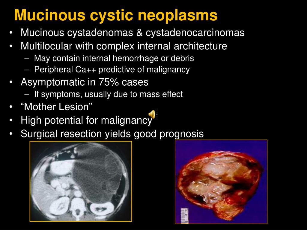 PPT - Imaging of Pancreatic Cystic Lesions PowerPoint Presentation ...