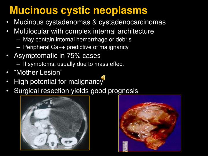 PPT - Imaging of Pancreatic Cystic Lesions PowerPoint Presentation - ID ...