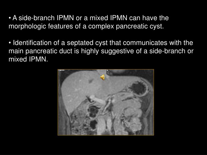 PPT - Imaging of Pancreatic Cystic Lesions PowerPoint Presentation - ID ...