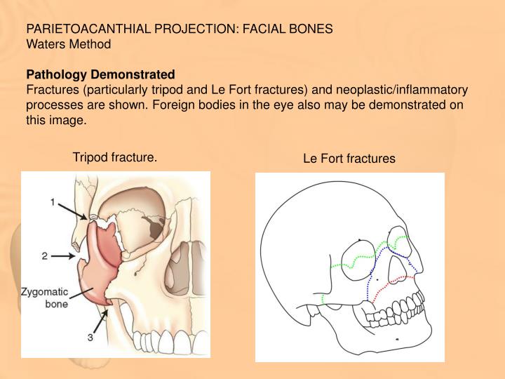 PPT - Facial Bones PowerPoint Presentation - ID:3478309
