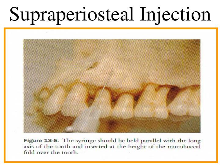 PPT - Maxillary Injection Techniques PowerPoint Presentation - ID:3480977