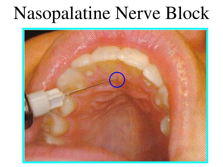PPT - Maxillary Injection Techniques PowerPoint Presentation - ID:3480977