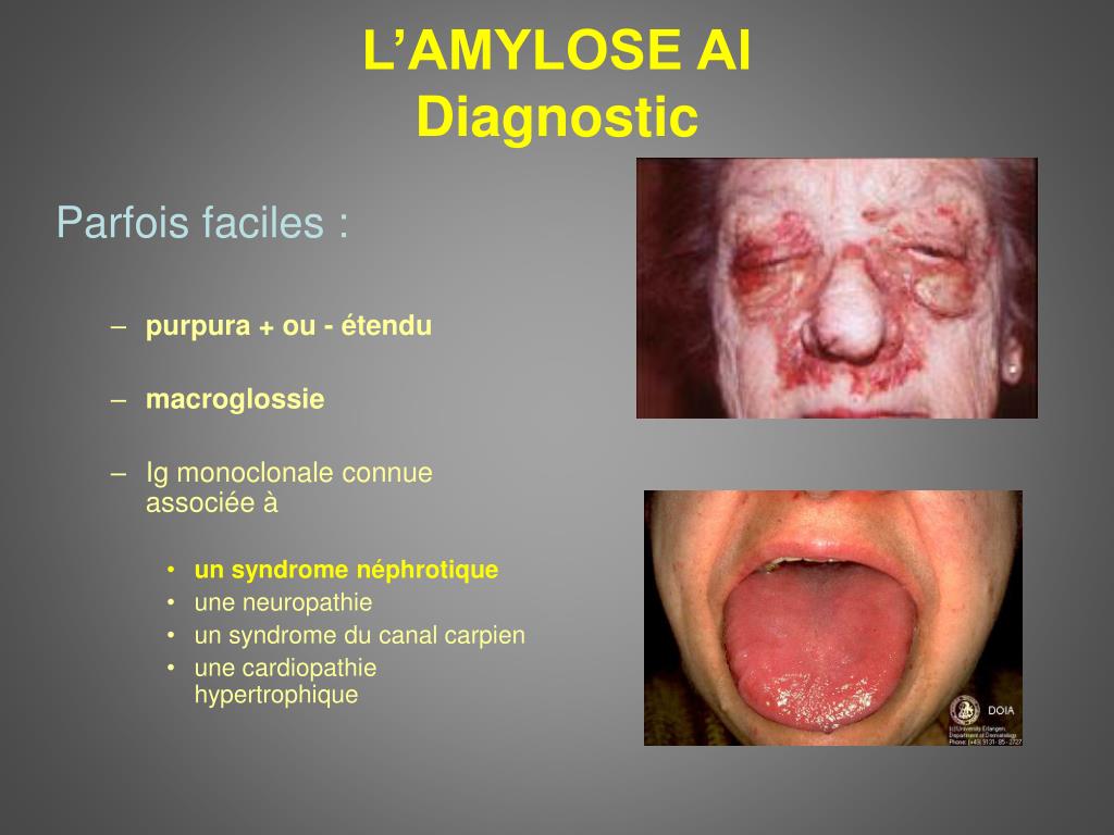 PPT - Les atteintes rénales des Gammapathies monoclonales PowerPoint ...