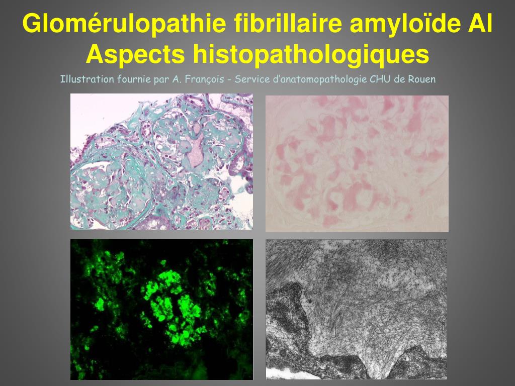 PPT - Les atteintes rénales des Gammapathies monoclonales PowerPoint ...