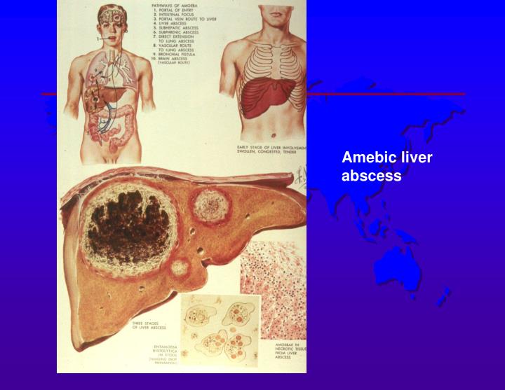 PPT - Amebiasis PowerPoint Presentation - ID:3484627