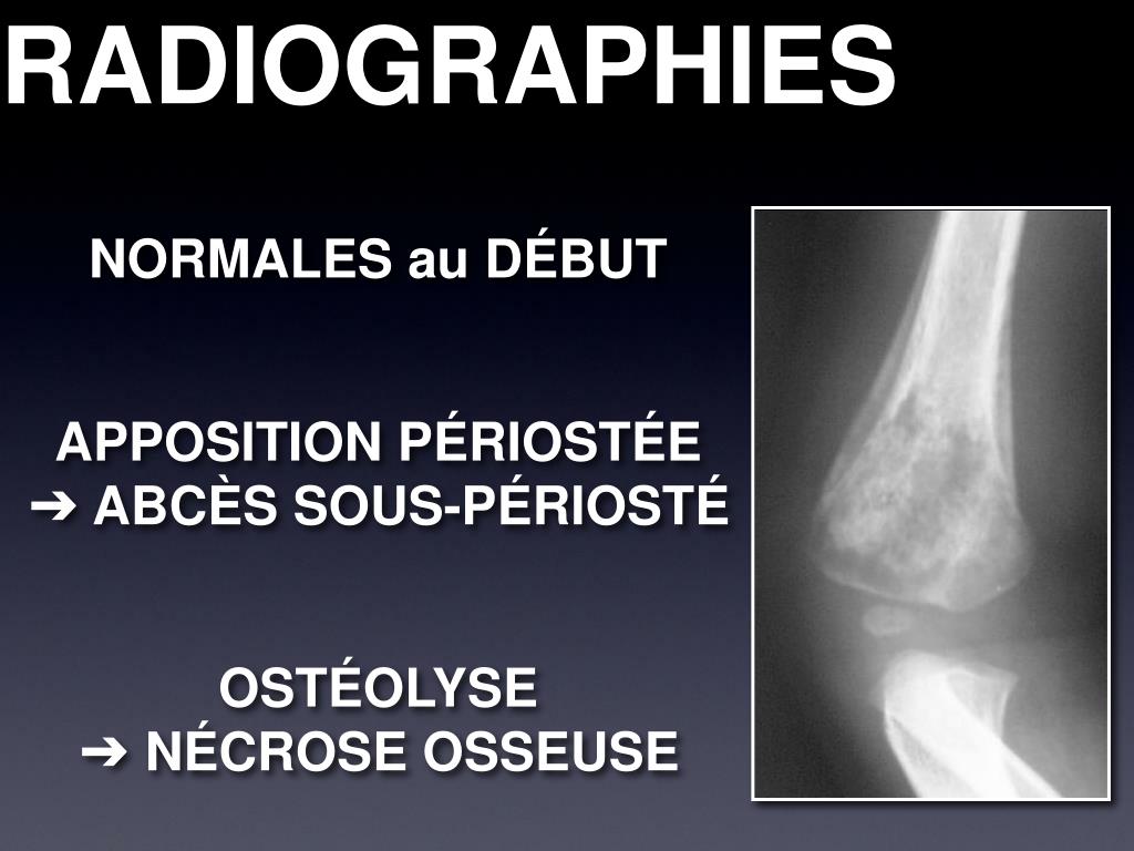 PPT - INFECTIONS OSTÉO-ARTICULAIRES DE L’ENFANT PowerPoint Presentation ...