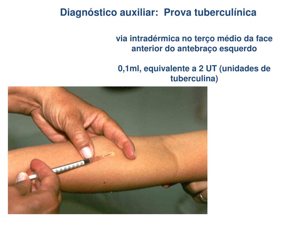 PPT - Vigilância Epidemiológica da Tuberculose PowerPoint Presentation ...