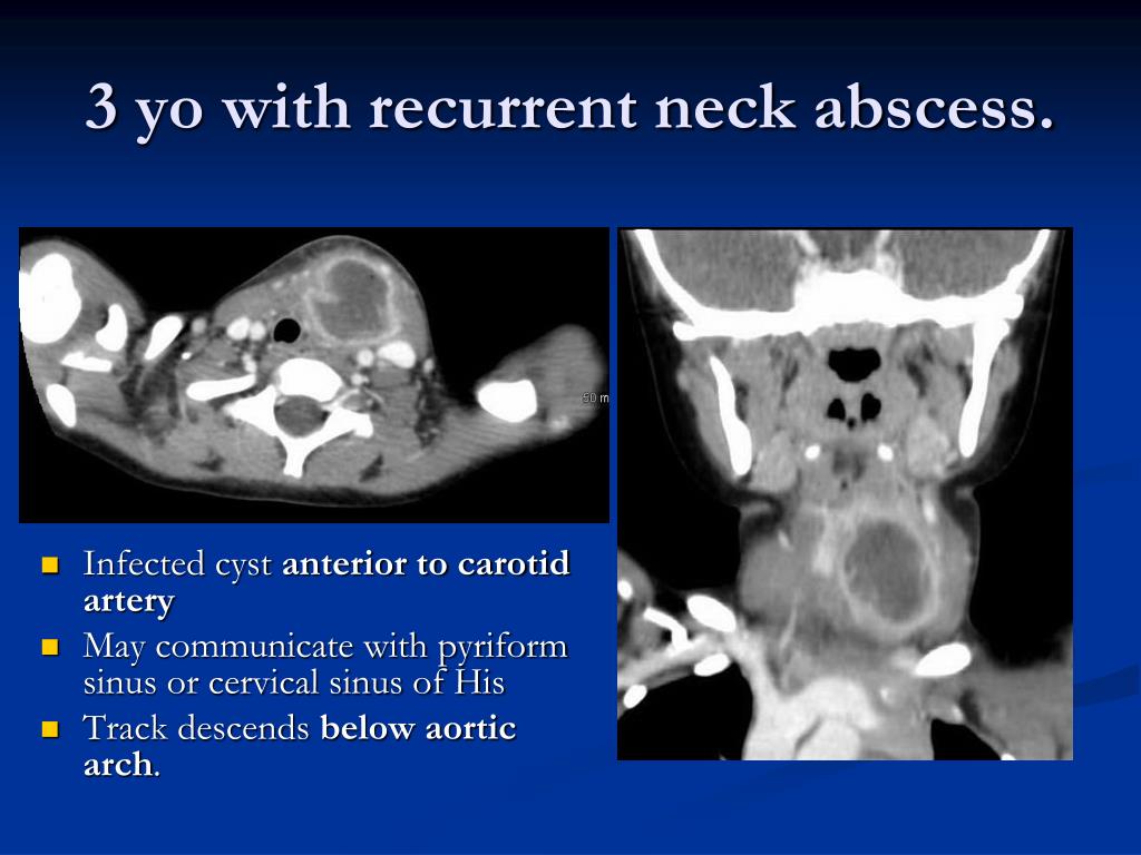 PPT - Pictoral Essay: Congenital Anomalies of the Branchial Apparatus ...