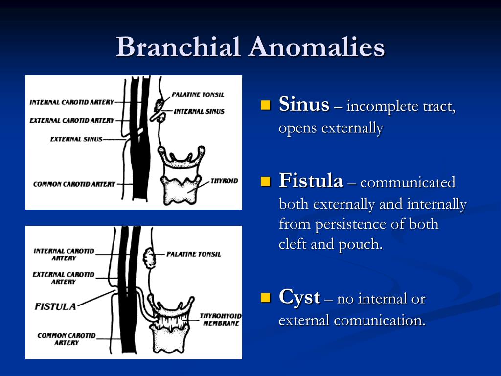 PPT - Pictoral Essay: Congenital Anomalies of the Branchial Apparatus ...