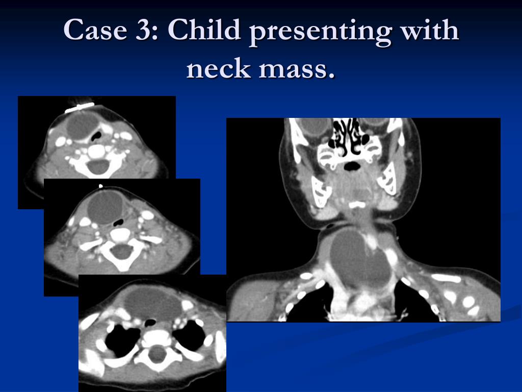 PPT - Pictoral Essay: Congenital Anomalies of the Branchial Apparatus ...