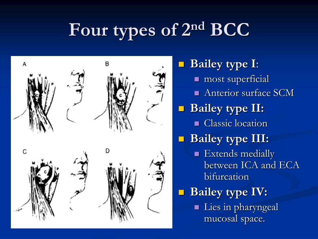 PPT - Pictoral Essay: Congenital Anomalies of the Branchial Apparatus ...