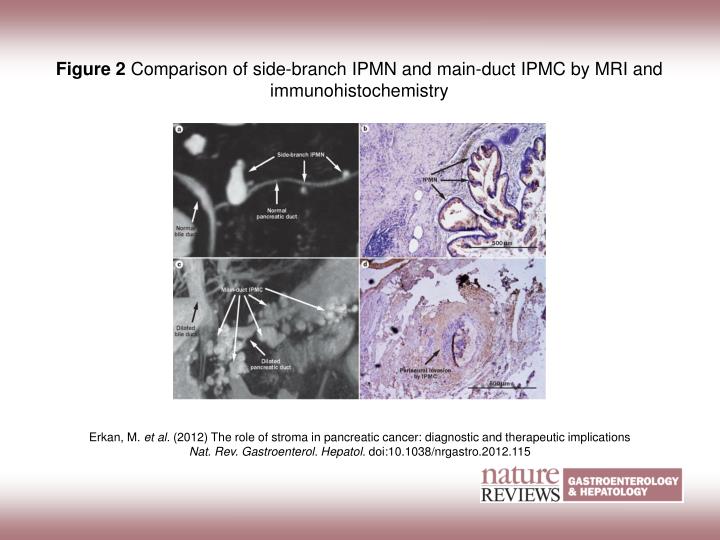 PPT - Figure 2 Comparison of side-branch IPMN and main-duct IPMC by MRI and immunohistochemistry ...