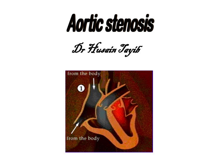 PPT - Aortic stenosis PowerPoint Presentation, free download - ID:3493665