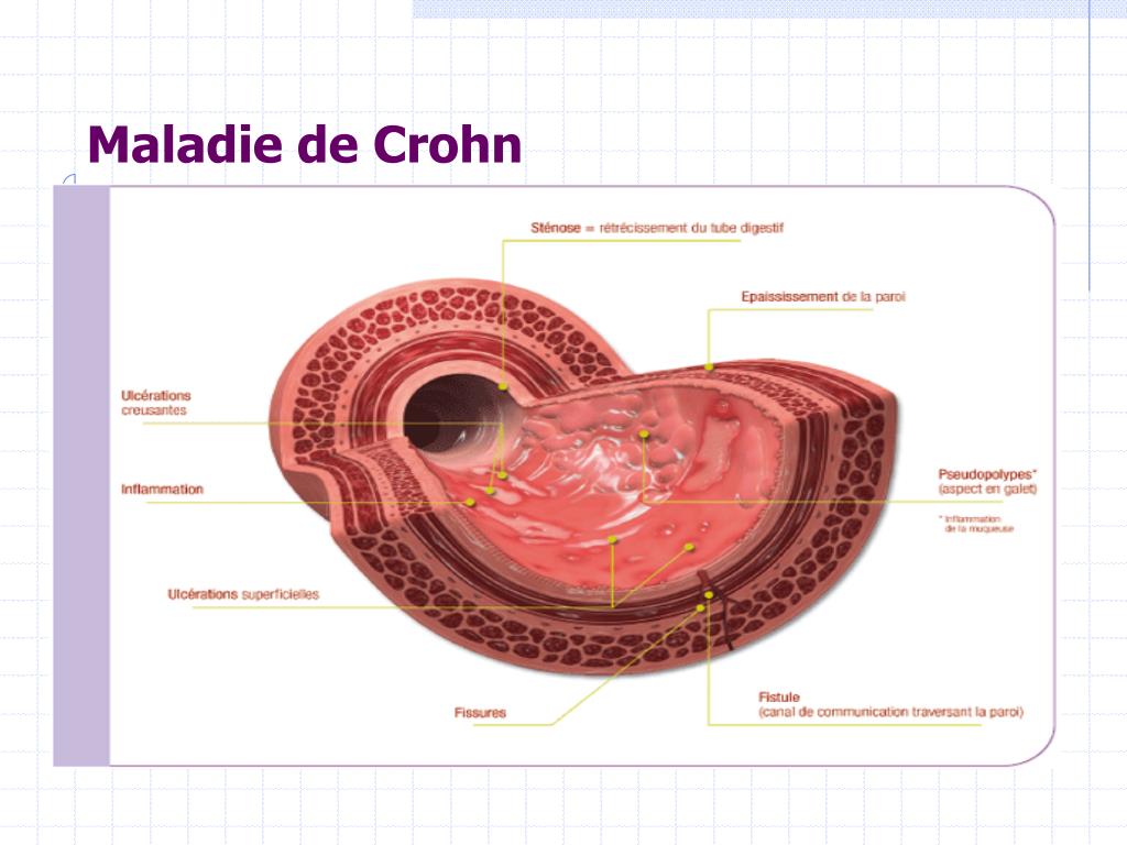 PPT - MALADIES INFLAMMATOIRES CHRONIQUES DE L ’ INTESTIN PowerPoint ...