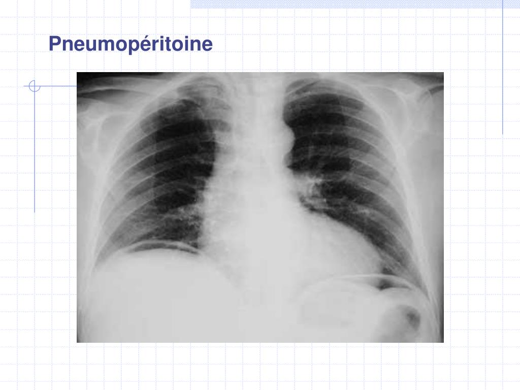 PPT - Érythème noueux PowerPoint Presentation, free download - ID:3495467