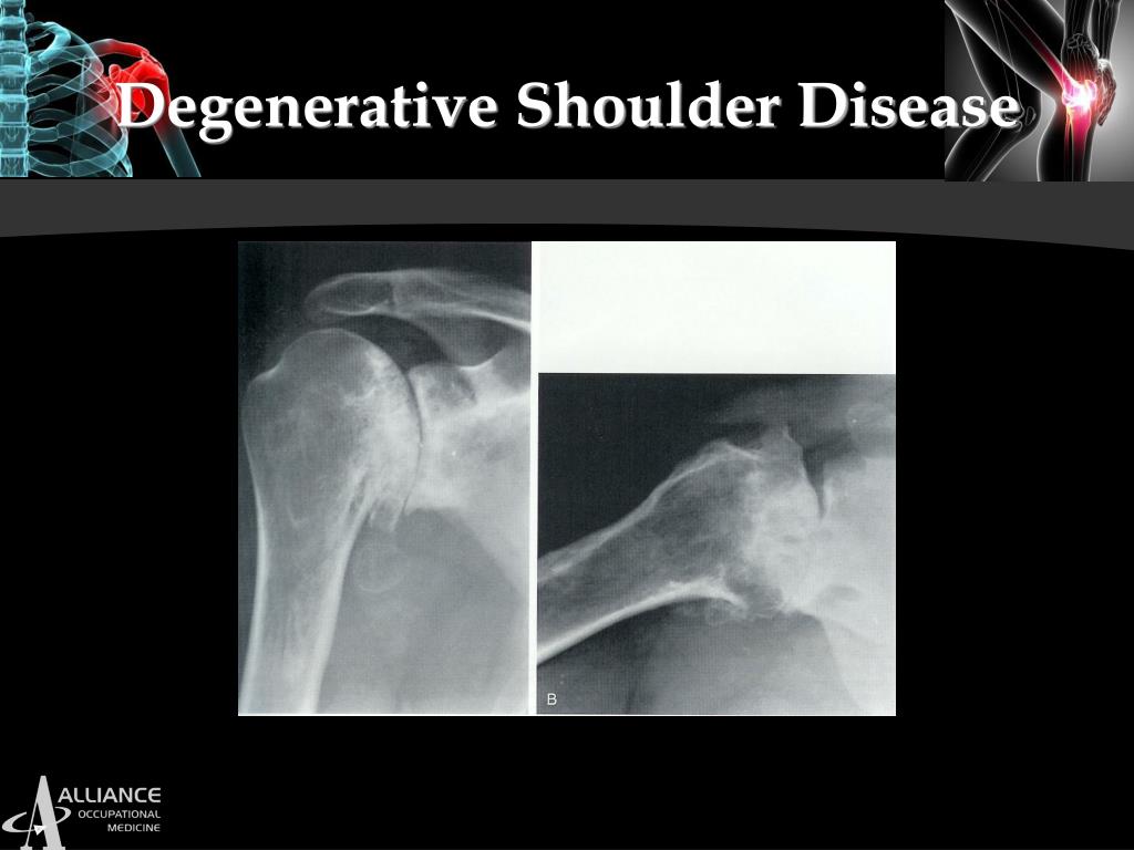 PPT - Shoulder and Knee Injury: Treatment and Prevention PowerPoint ...