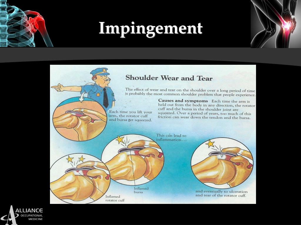 PPT - Shoulder and Knee Injury: Treatment and Prevention PowerPoint ...