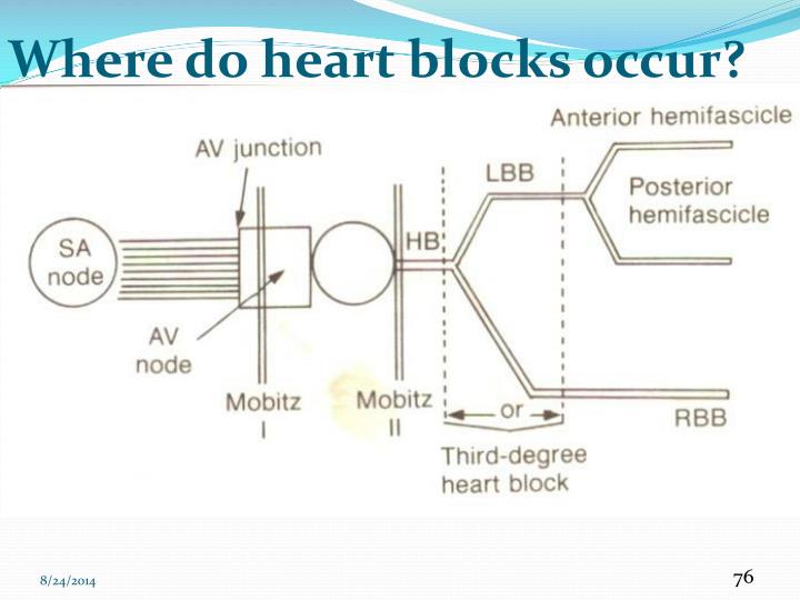 PPT - ECG Basics Module 2( Arrhythmias level 1) PowerPoint Presentation ...