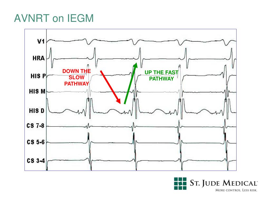 PPT - The Electrical Management of Cardiac Rhythm Disorders Tachycardia ...