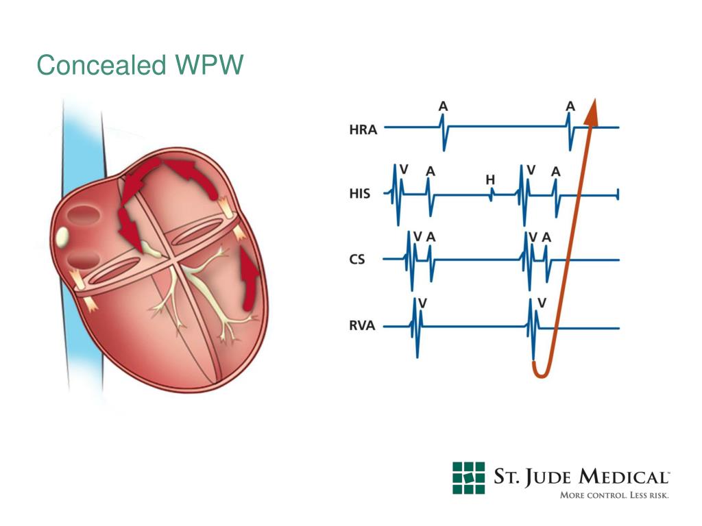 PPT - The Electrical Management of Cardiac Rhythm Disorders Tachycardia ...