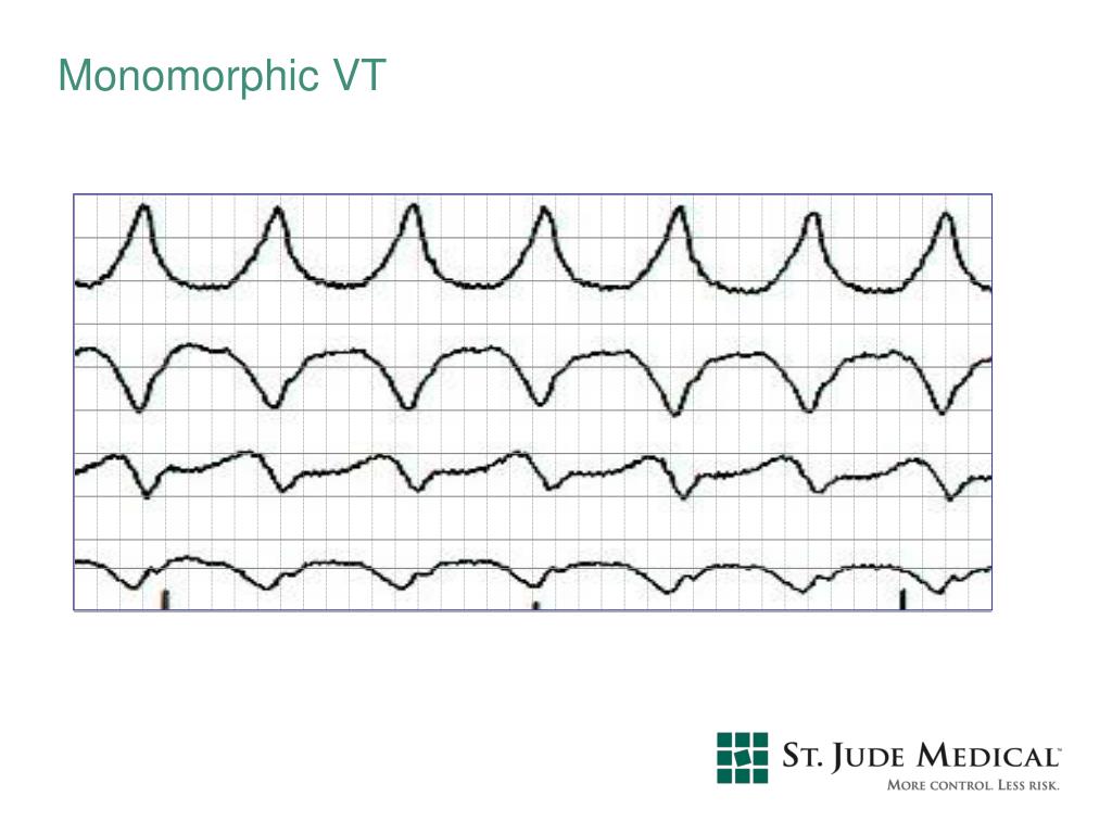 PPT - The Electrical Management of Cardiac Rhythm Disorders Tachycardia ...