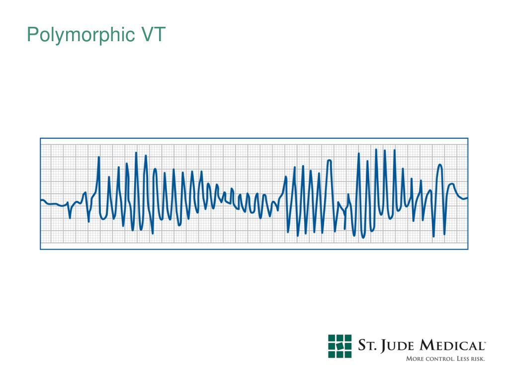 PPT - The Electrical Management of Cardiac Rhythm Disorders Tachycardia ...