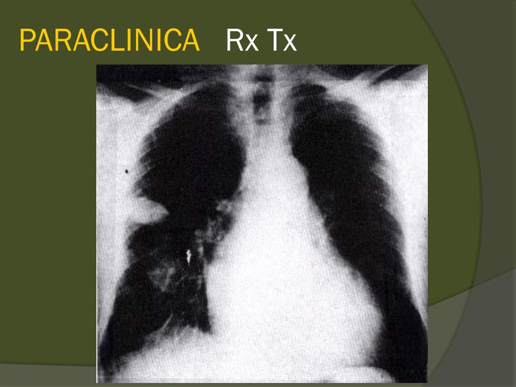 PPT - Actualización en el tratamiento de la insuficiencia cardiaca ...