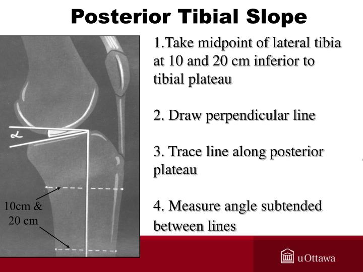 PPT - Osteotomies about the Knee PowerPoint Presentation - ID:3504301