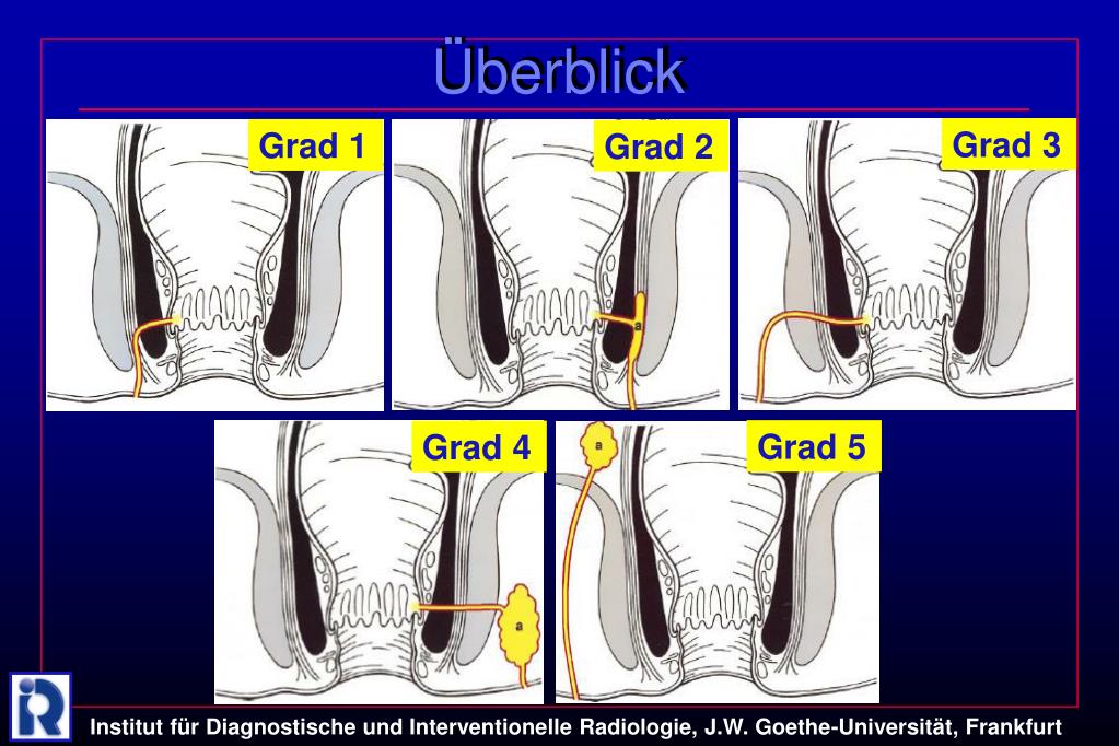PPT - MR-morphologische Einteilung der perianalen Fisteln PowerPoint ...