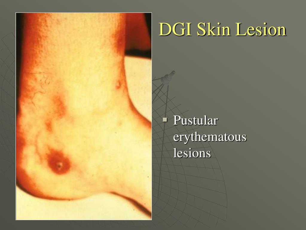 PPT - Gonorrhea , trichomoniasis , chlamidiosis , candidal and mycotic ...