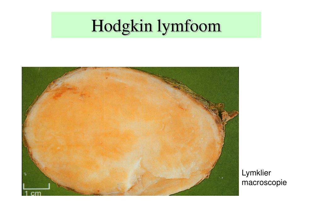 PPT - Hodgkin lymfoom Blok 4 oncologie, oktober 2011 PowerPoint ...