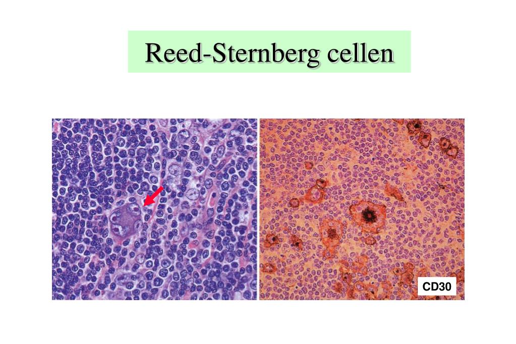 PPT - Hodgkin lymfoom Blok 4 oncologie, oktober 2011 PowerPoint ...