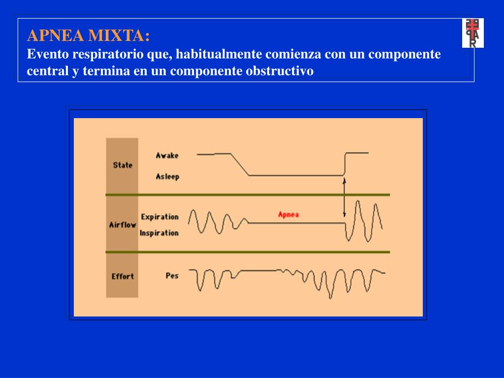 PPT - Síndrome de Apnea-Hipoapnea del Sueño (SAHS) PowerPoint ...