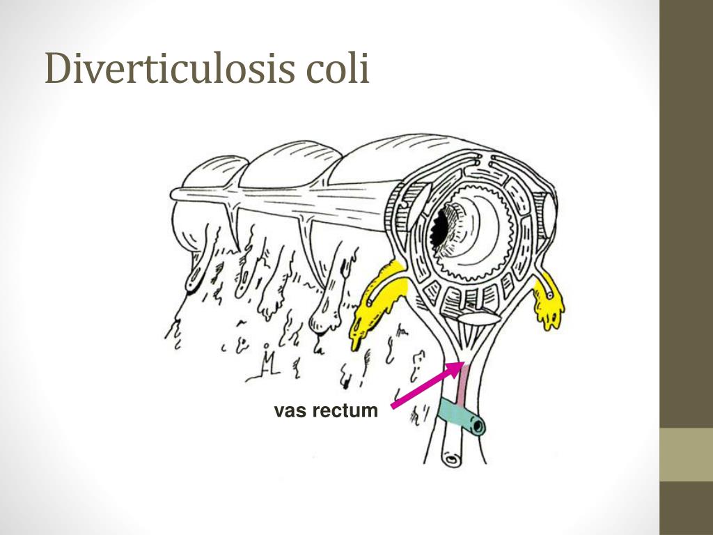 PPT - Hoe, wat, waar en wanneer bij diverticulitis PowerPoint ...