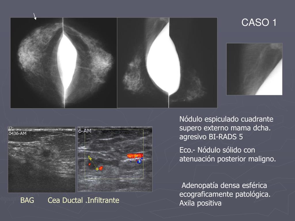 Nodulo Obscurecido Na Mama é Perigoso - RETOEDU