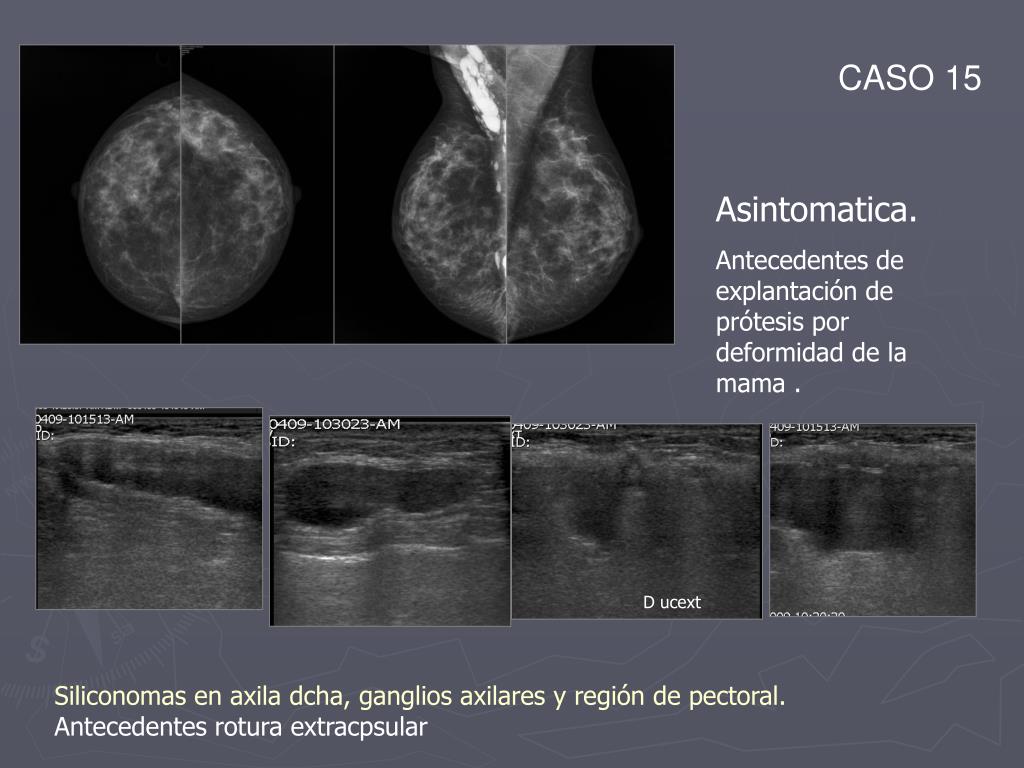 PPT - Nódulo espiculado cuadrante supero externo mama dcha. agresivo BI ...