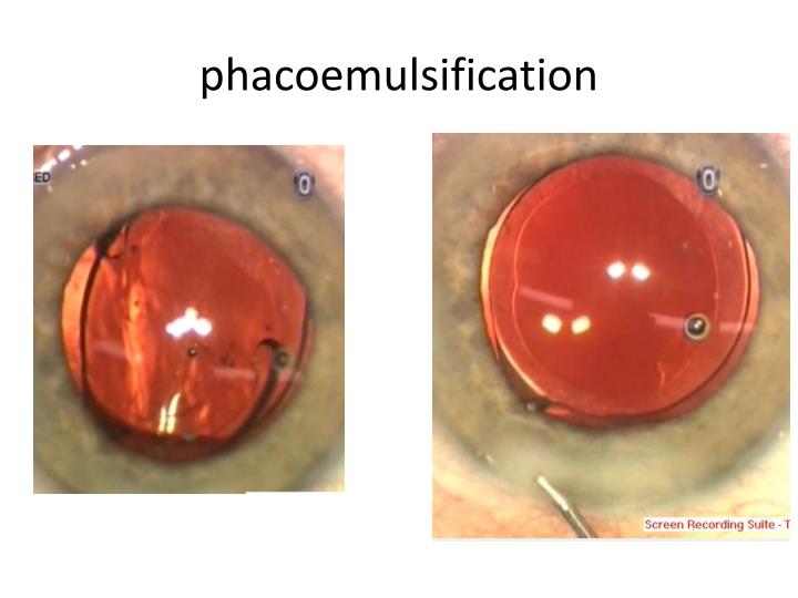 PPT - Cataract and cataract surgery PowerPoint Presentation - ID:3518536