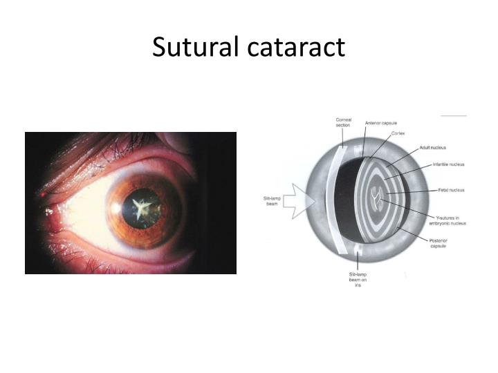 PPT - Cataract and cataract surgery PowerPoint Presentation - ID:3518536