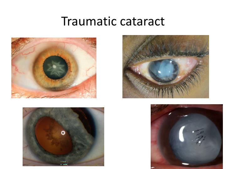 PPT - Cataract and cataract surgery PowerPoint Presentation - ID:3518536