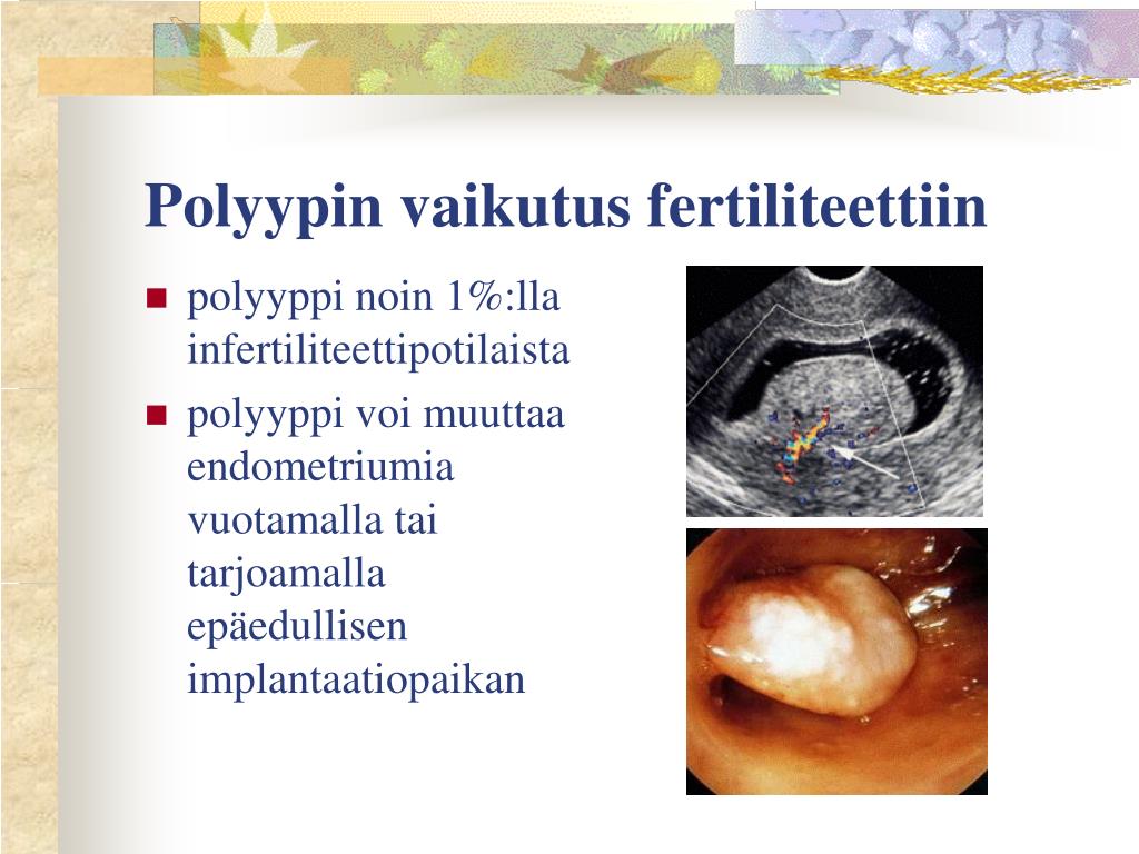 PPT - Endometriumpolyyppien hoitoperiaatteet Päivi Härkki GKS 29.9.2006 ...