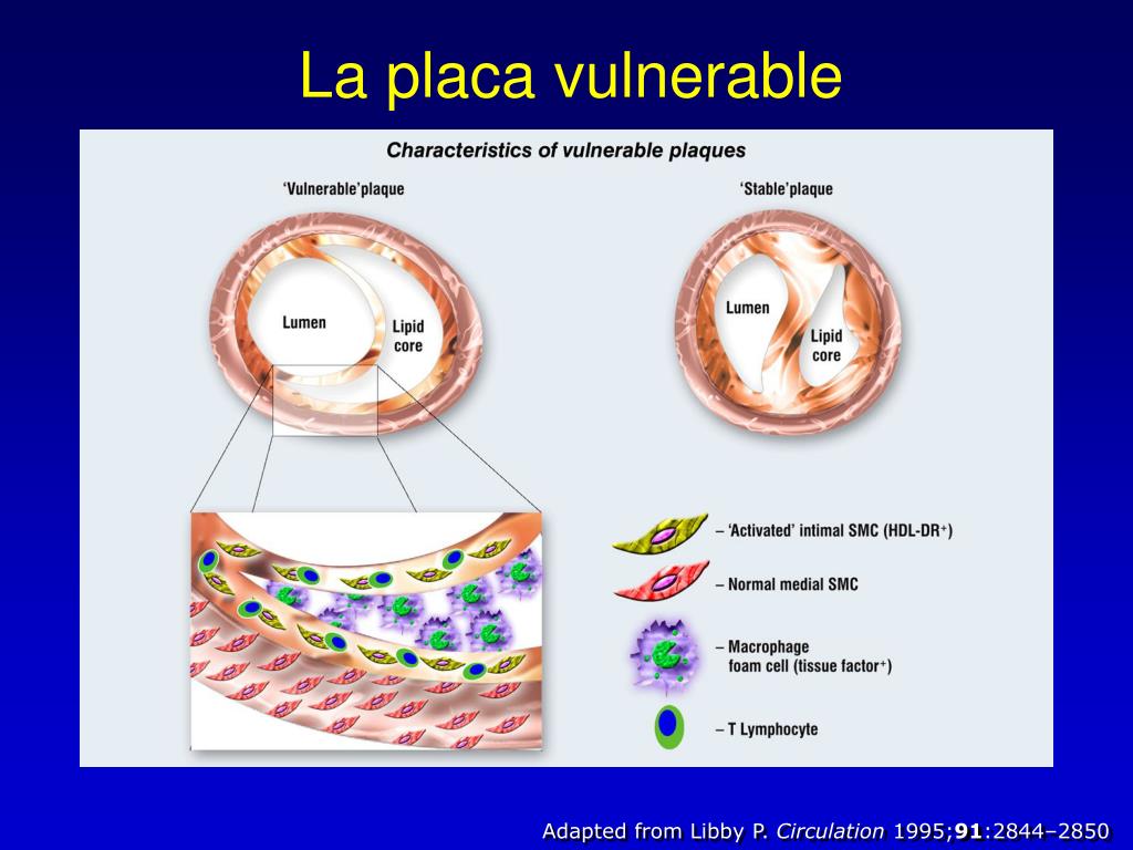 PPT - Aterosclerosis Dra. Verónica Irribarra Depto. Nutrición Diabetes ...
